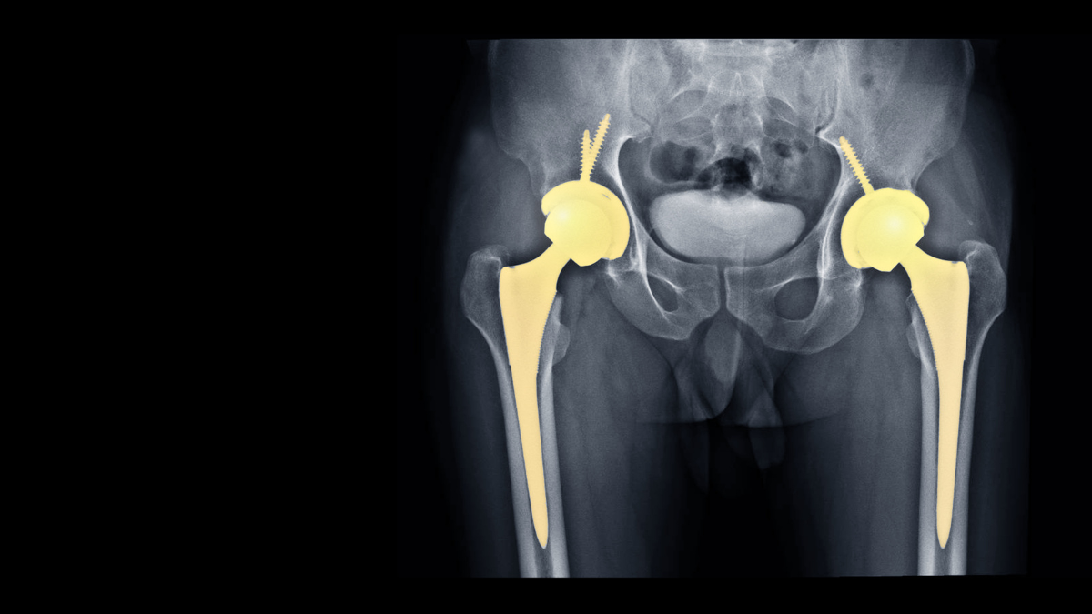Partial vs. Total Hip Replacement: Which one is better?